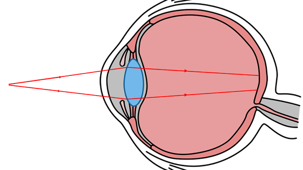 Hyperopia - Key Stage Wiki