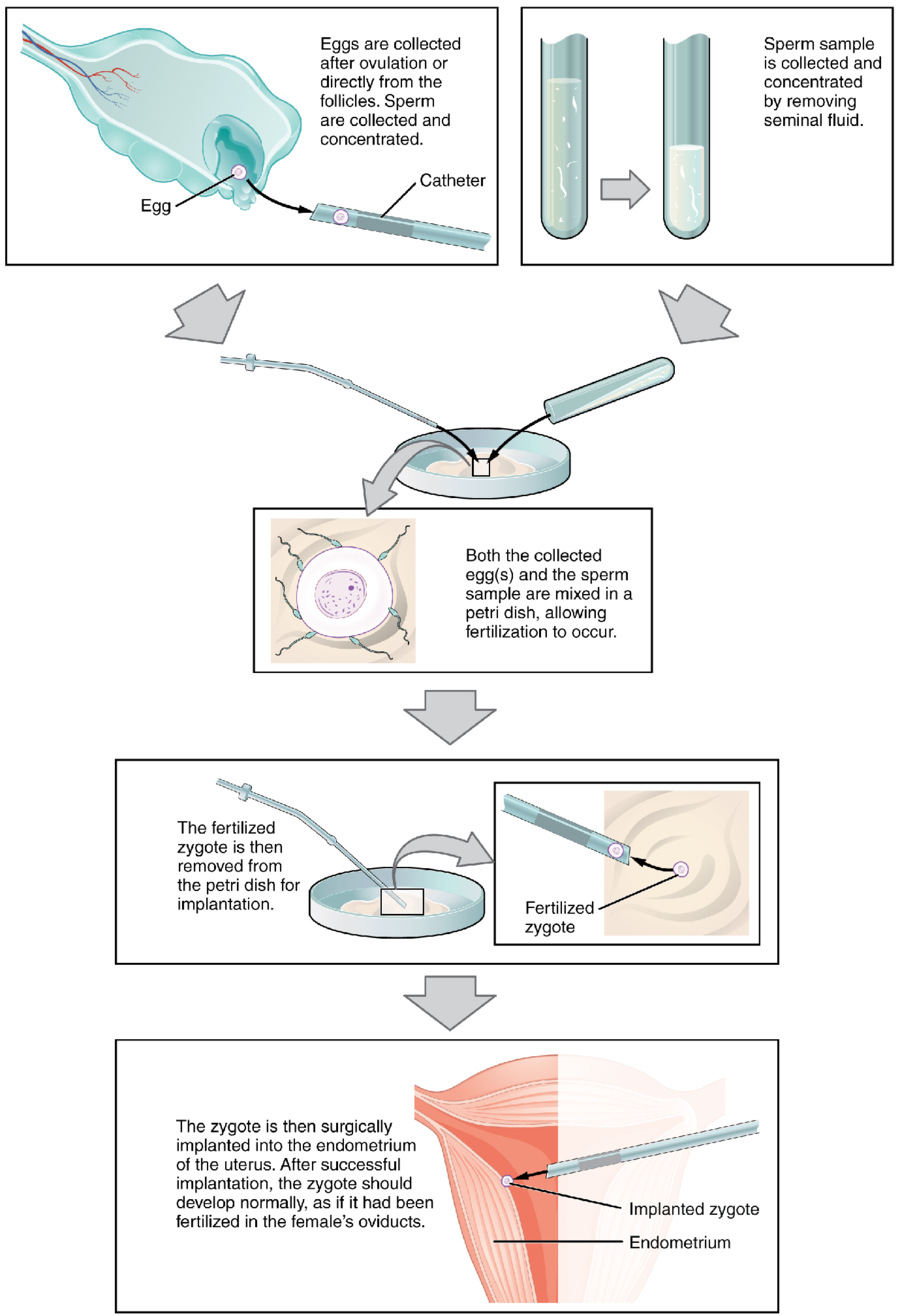 In Vitro Fertilisation - Key Stage Wiki